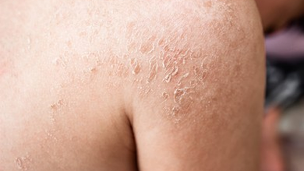 How Sunburn Affects Your Skin: Understand the Long-Term Effects - Dr ...